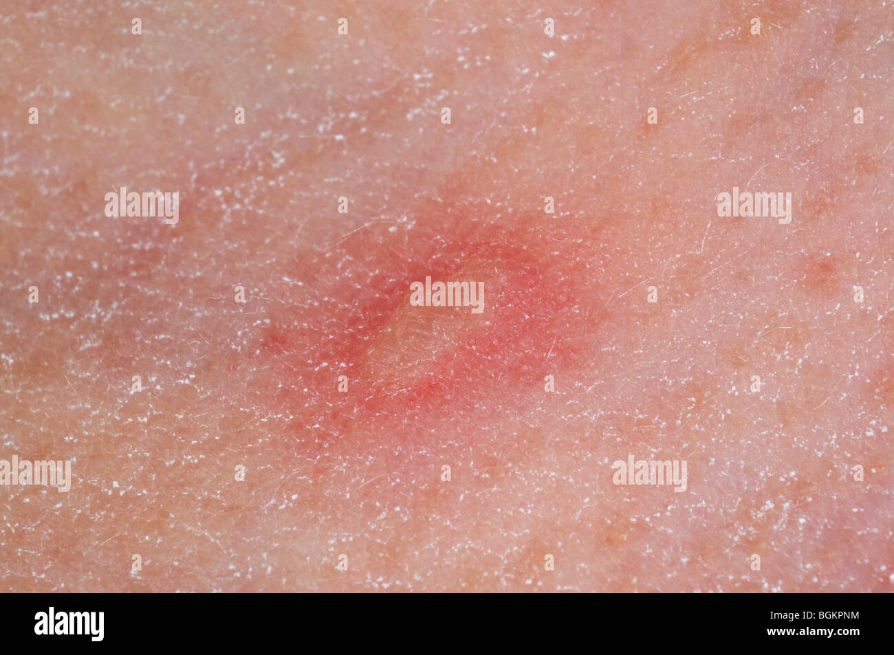 close up photograph of chicken pox vesicles on a young girl Stock Photo ...