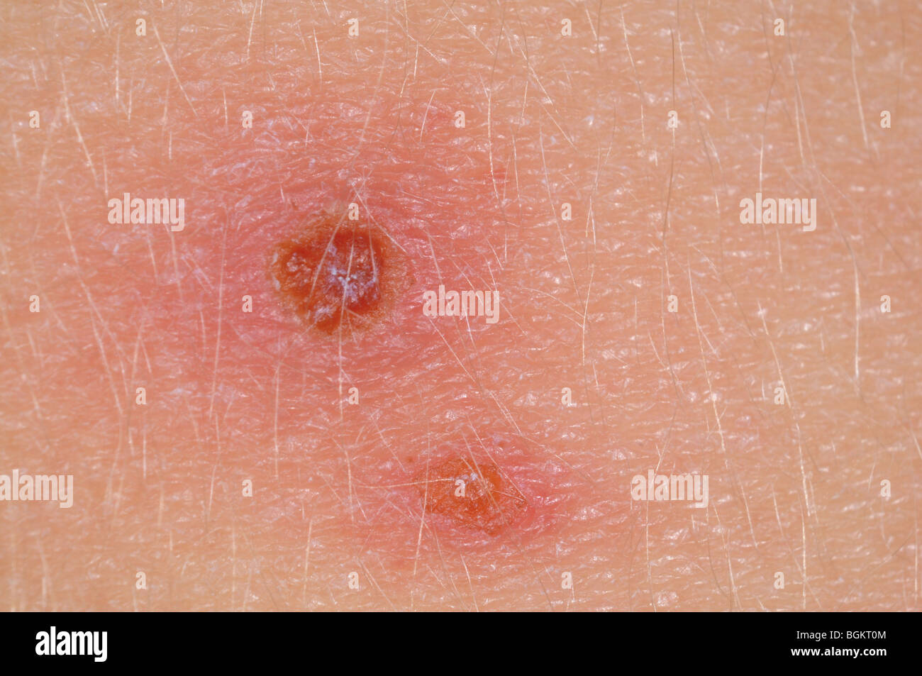 close up photograph of chicken pox vesicles on a young girl Stock Photo ...