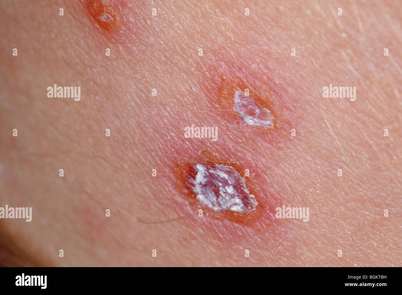 close up photograph of chicken pox vesicles on a young girl Stock Photo ...
