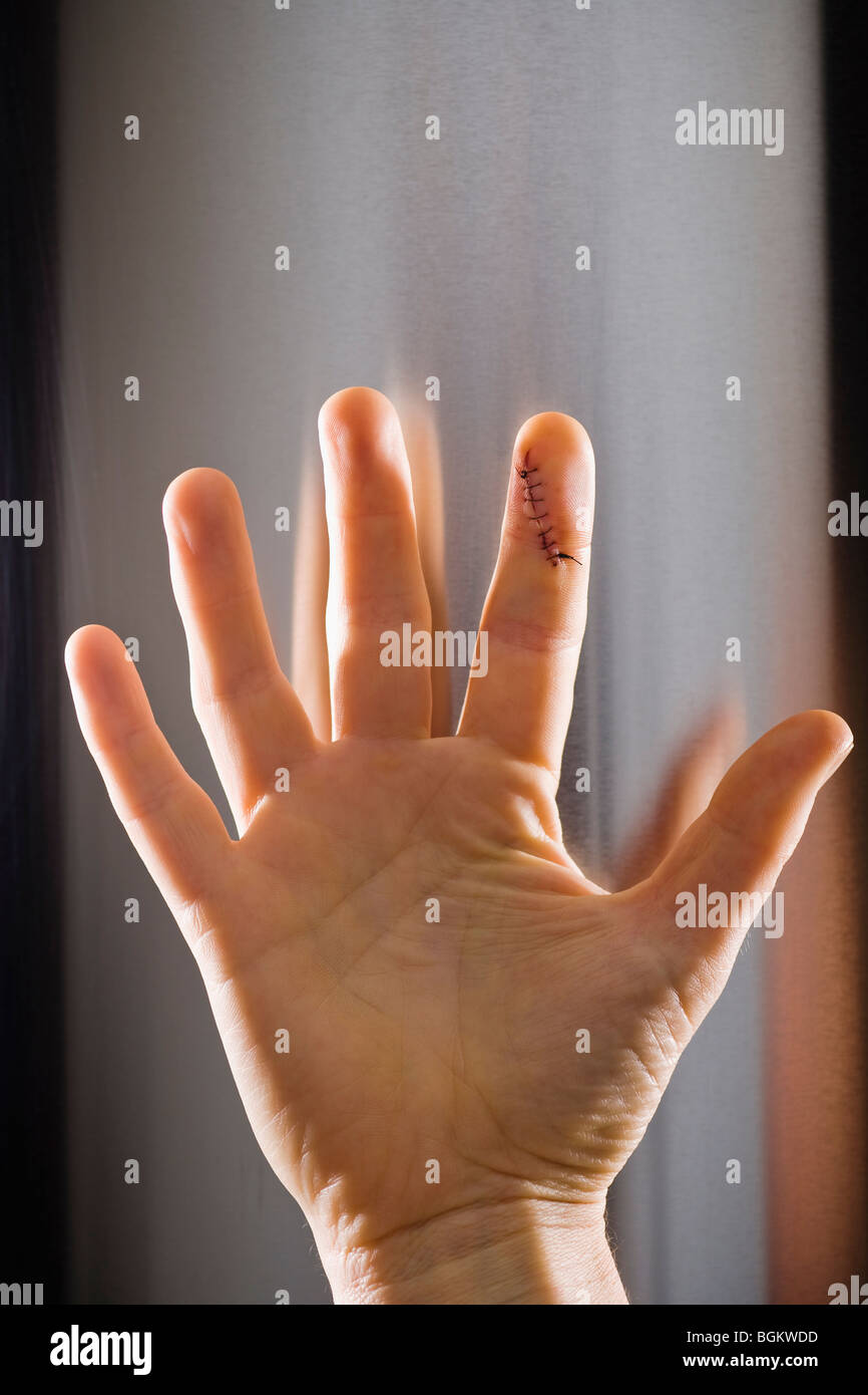 A womans hands with a stitched up cut on the index finger Stock Photo ...