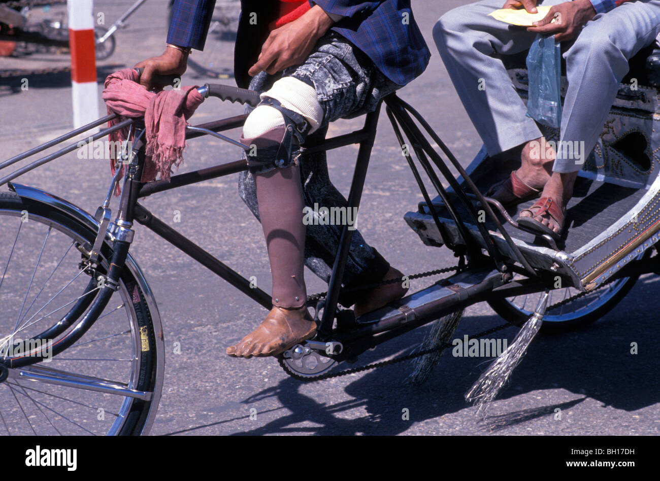 India. Disabled patient fitted with artificial 'Jaipur Limb' prosthesis ...