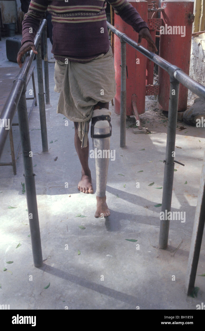 India. Disabled patients trying an artificial 'Jaipur Limb' prosthesis ...