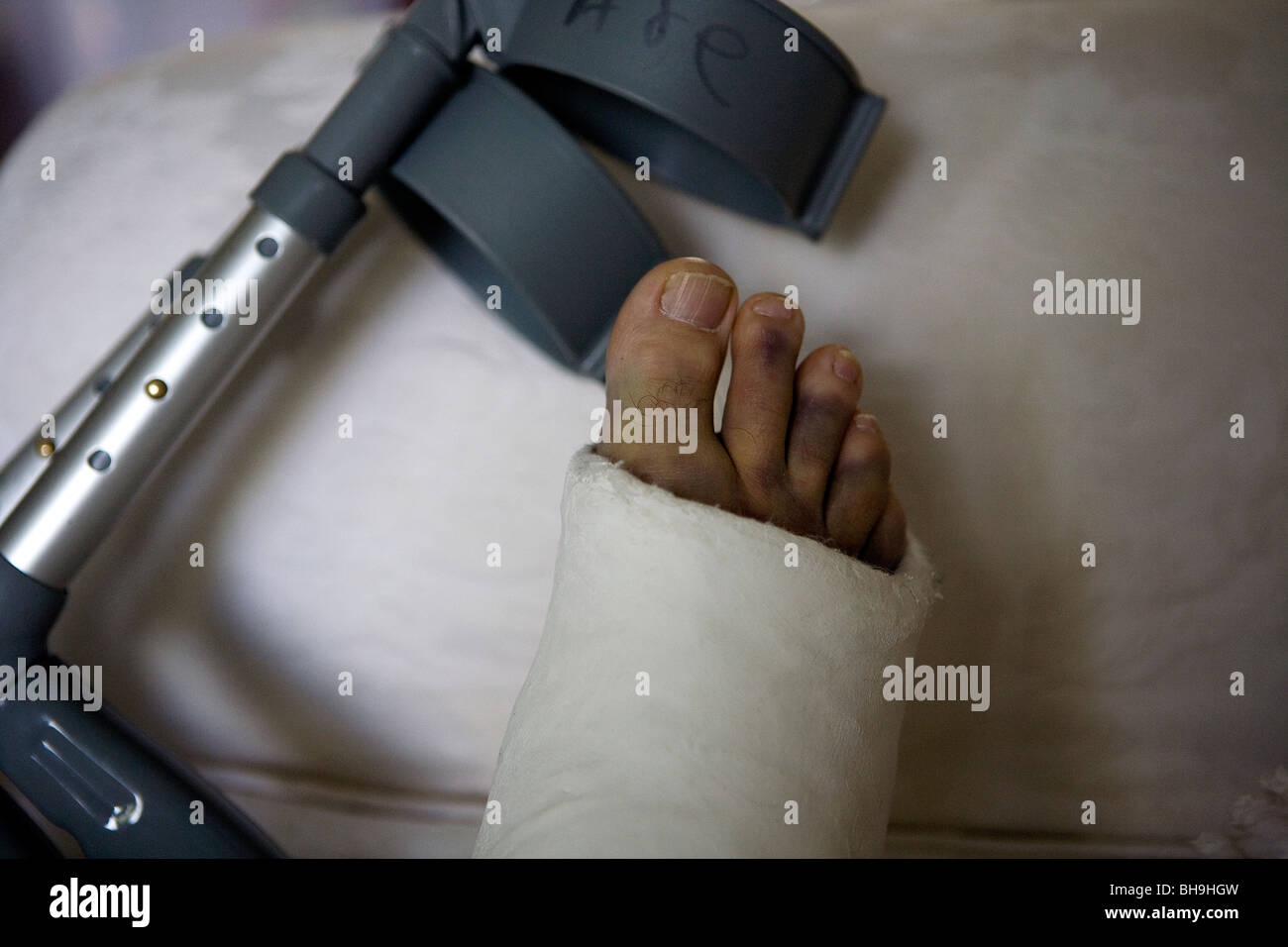 Healing fractured leg hi-res stock photography and images - Alamy