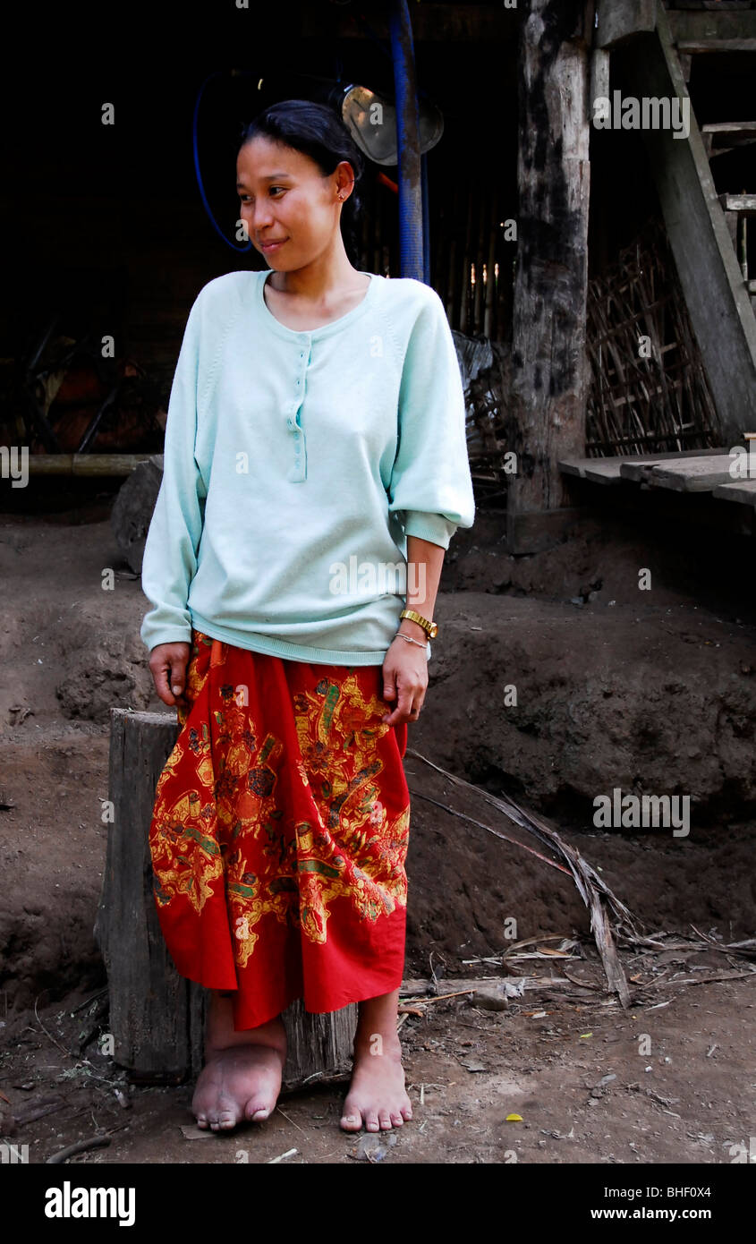 A Karen women suffering from Elephantiasis with bloated leg ,mae la ...