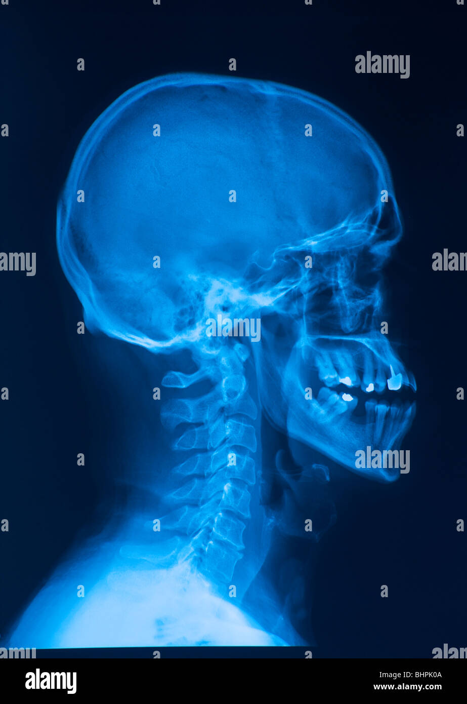side skull x-ray image Stock Photo - Alamy
