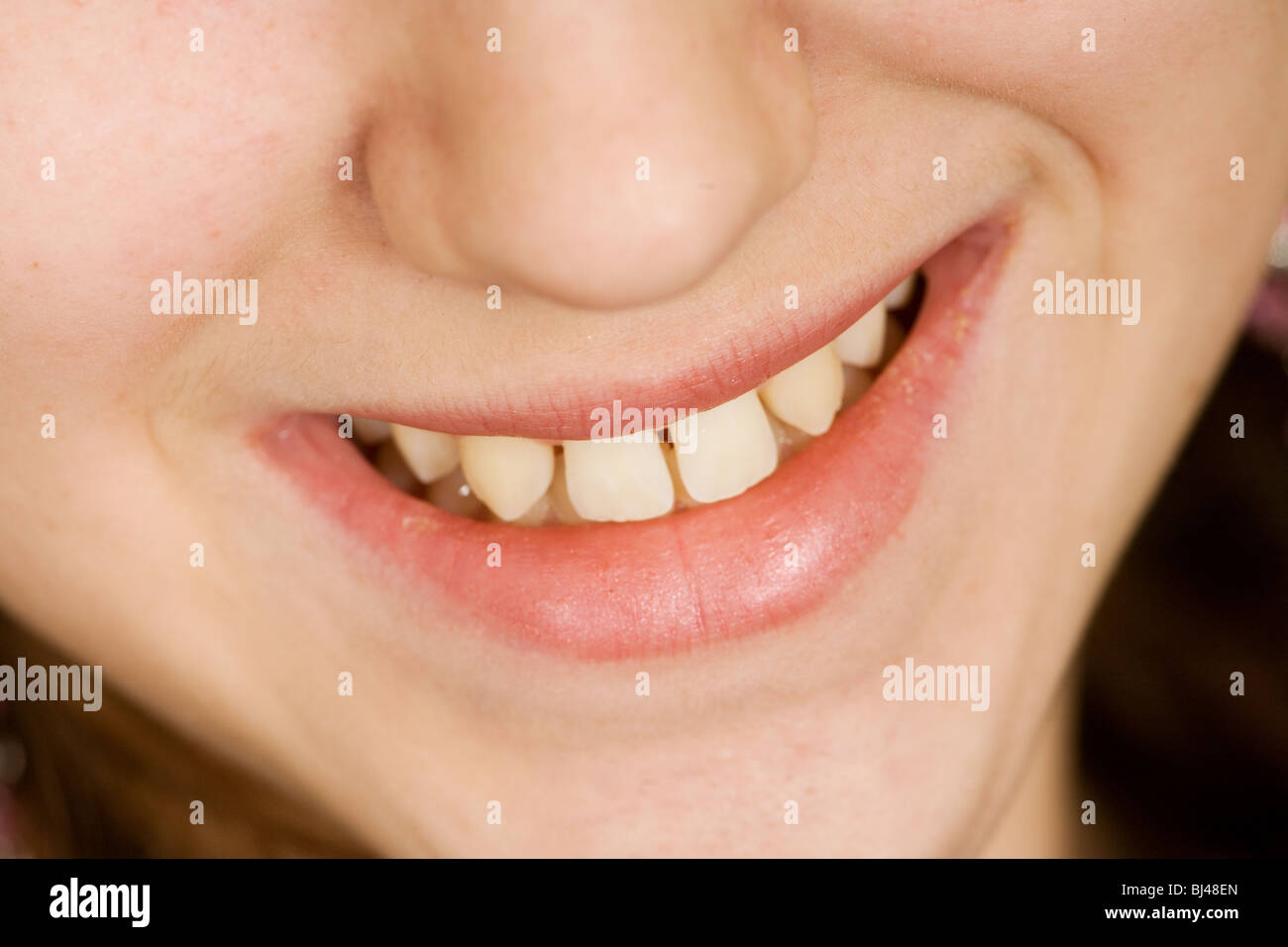 Teenage girl with teeth that need of dental work Stock Photo - Alamy