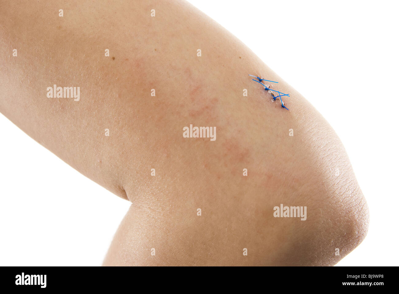 stitched up injury Stock Photo - Alamy
