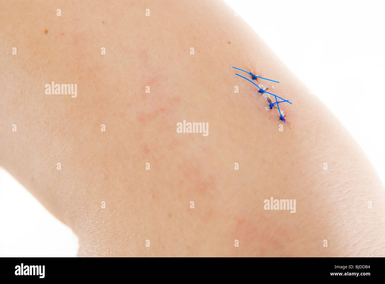 stitched up injury Stock Photo - Alamy