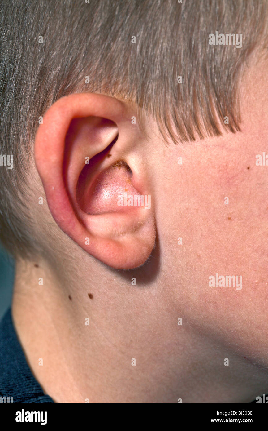 Outer Ear Stock Photos & Outer Ear Stock Images - Alamy