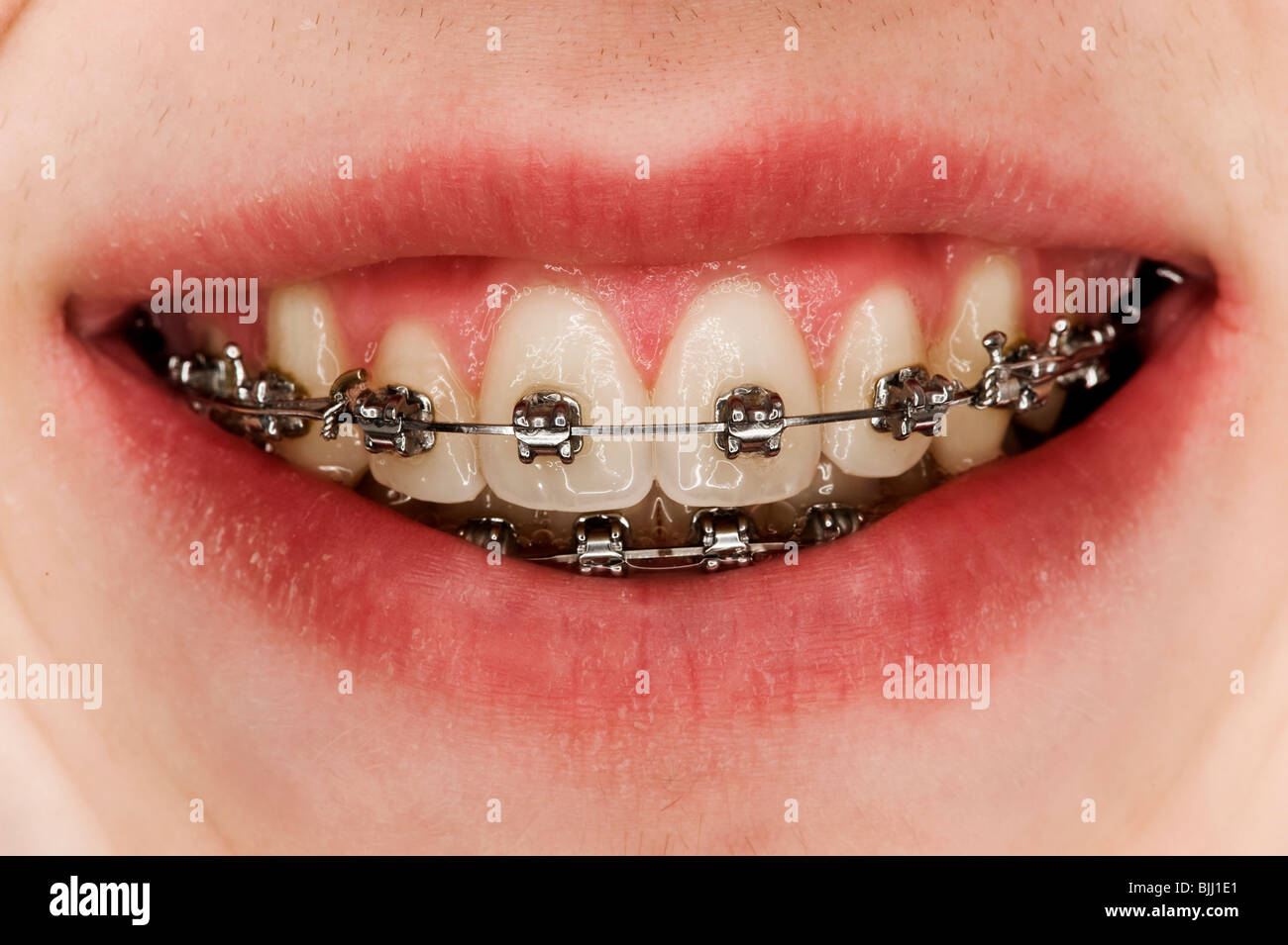Braces For Teeth Design