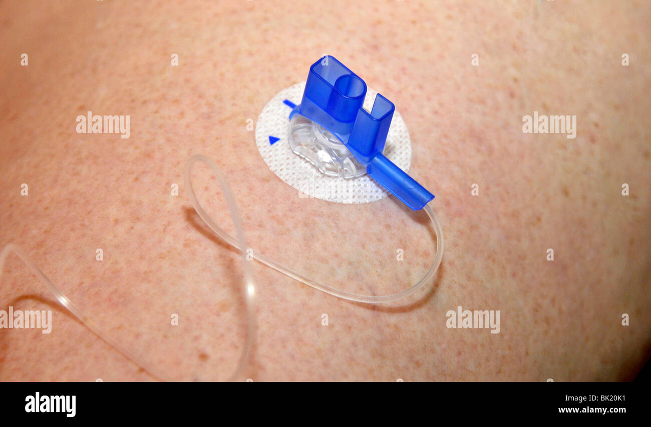 Type 2 diabetes hi-res stock photography and images - Alamy