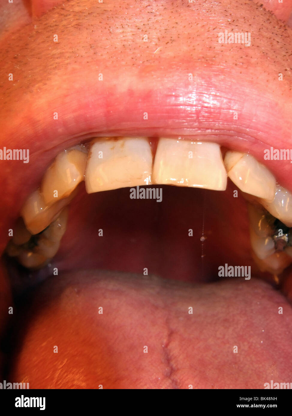 Human mouth open wide teeth hi-res stock photography and images - Alamy
