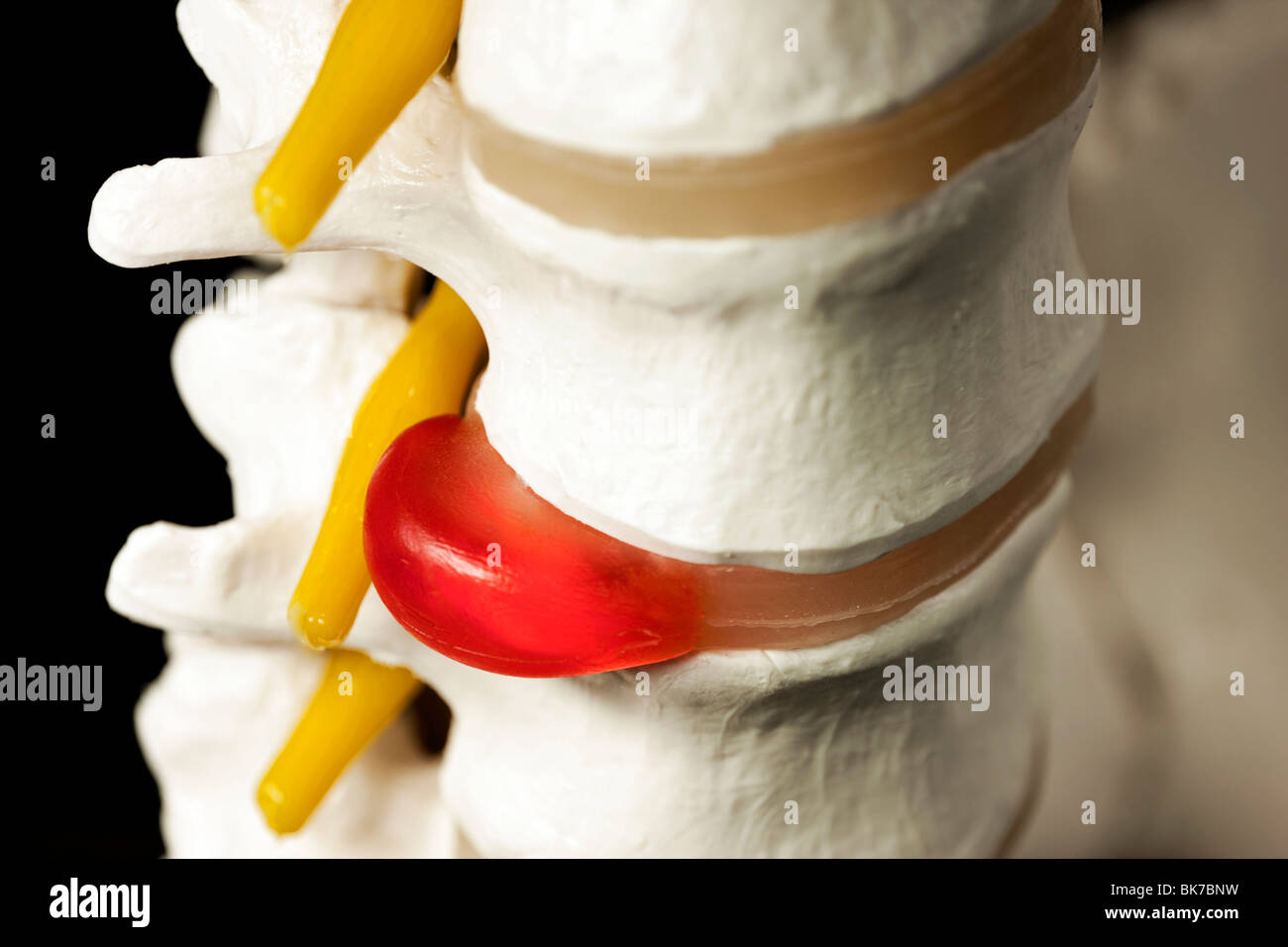 Slipped vertebrae hi-res stock photography and images - Alamy