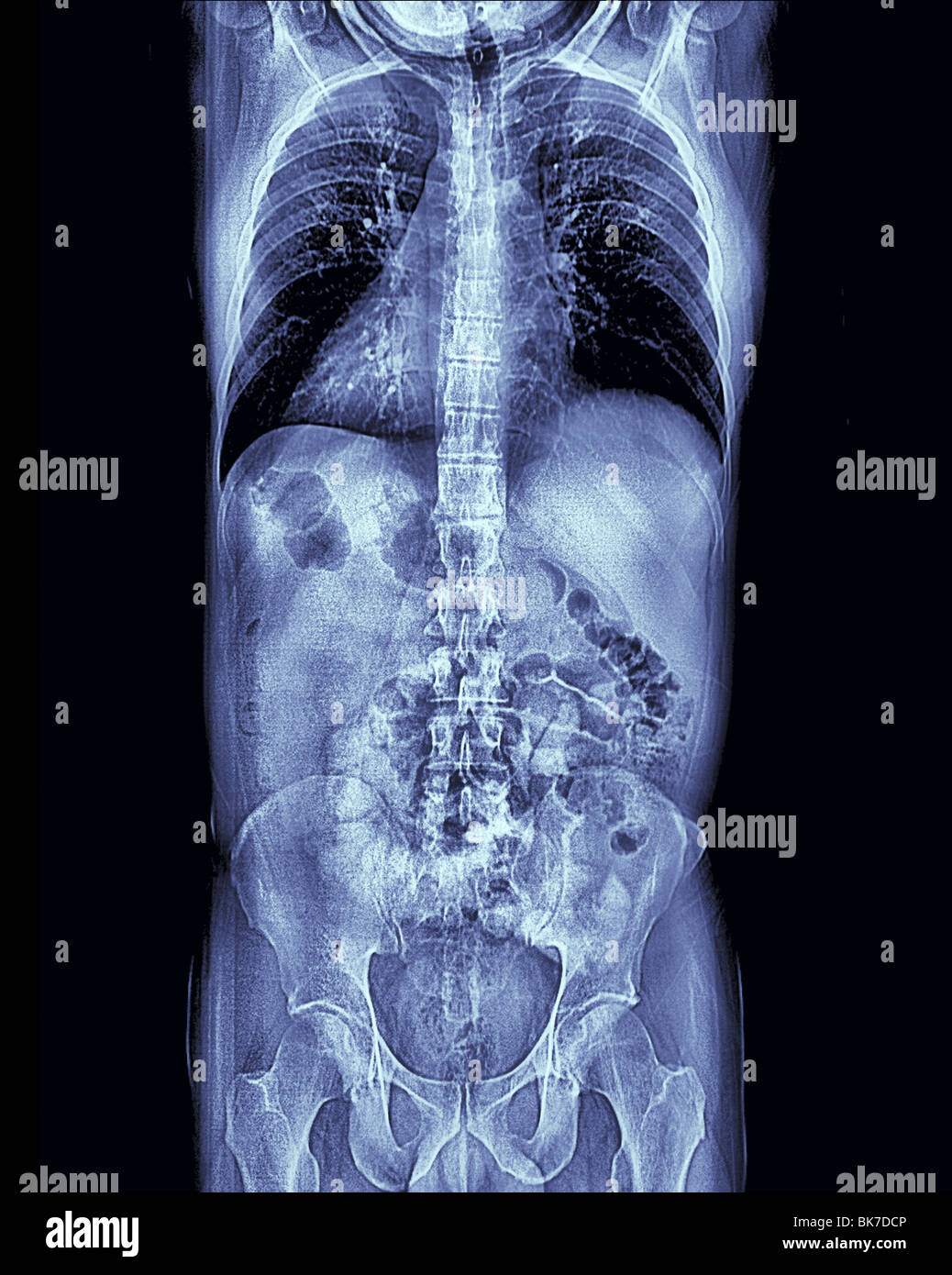 Human torso, MRI scan Stock Photo - Alamy