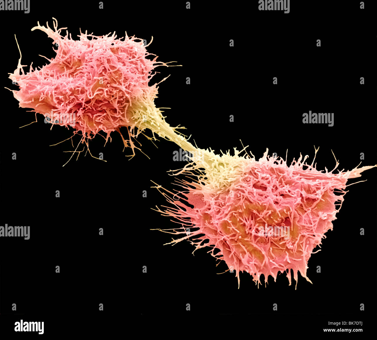 Fibrosarcoma hi-res stock photography and images - Alamy