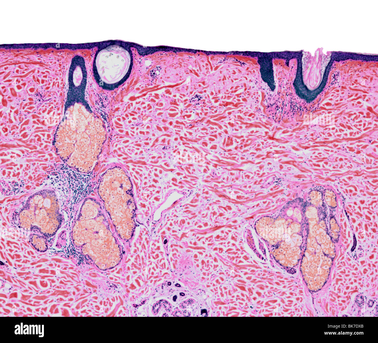 Bald scalp, light micrograph Stock Photo - Alamy