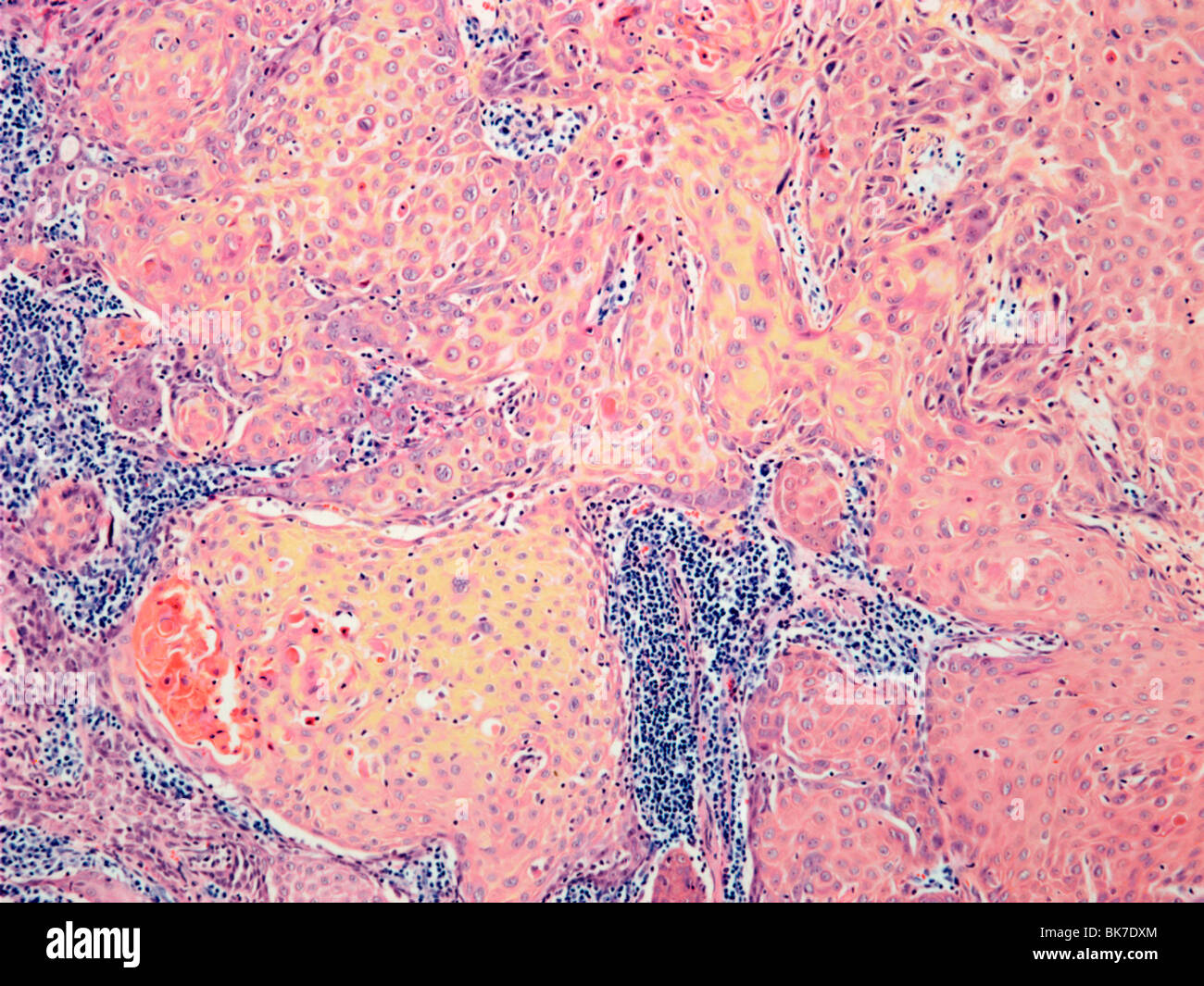 Tongue cancer hi-res stock photography and images - Alamy