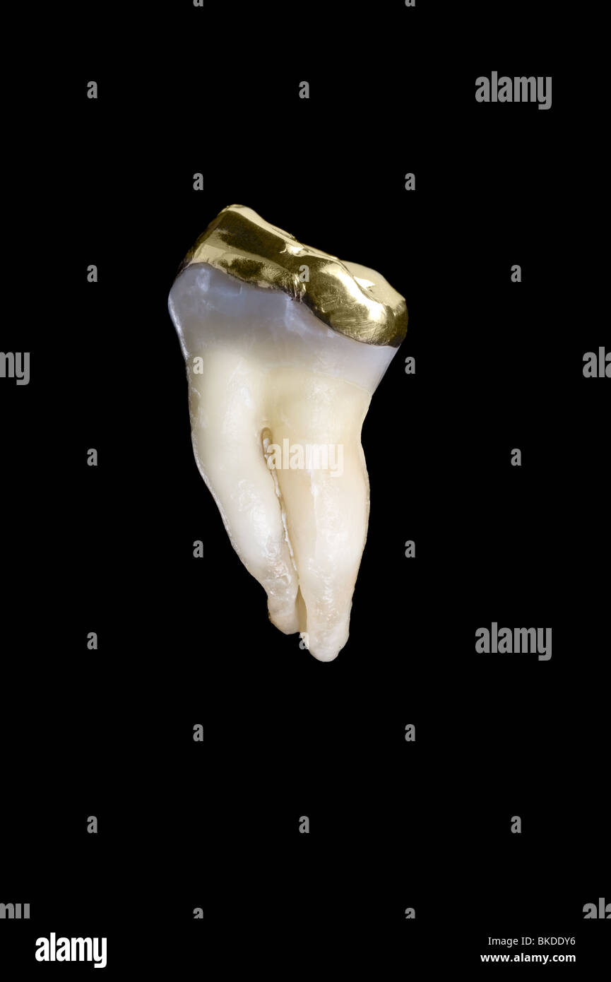 Molar tooth hi-res stock photography and images - Alamy