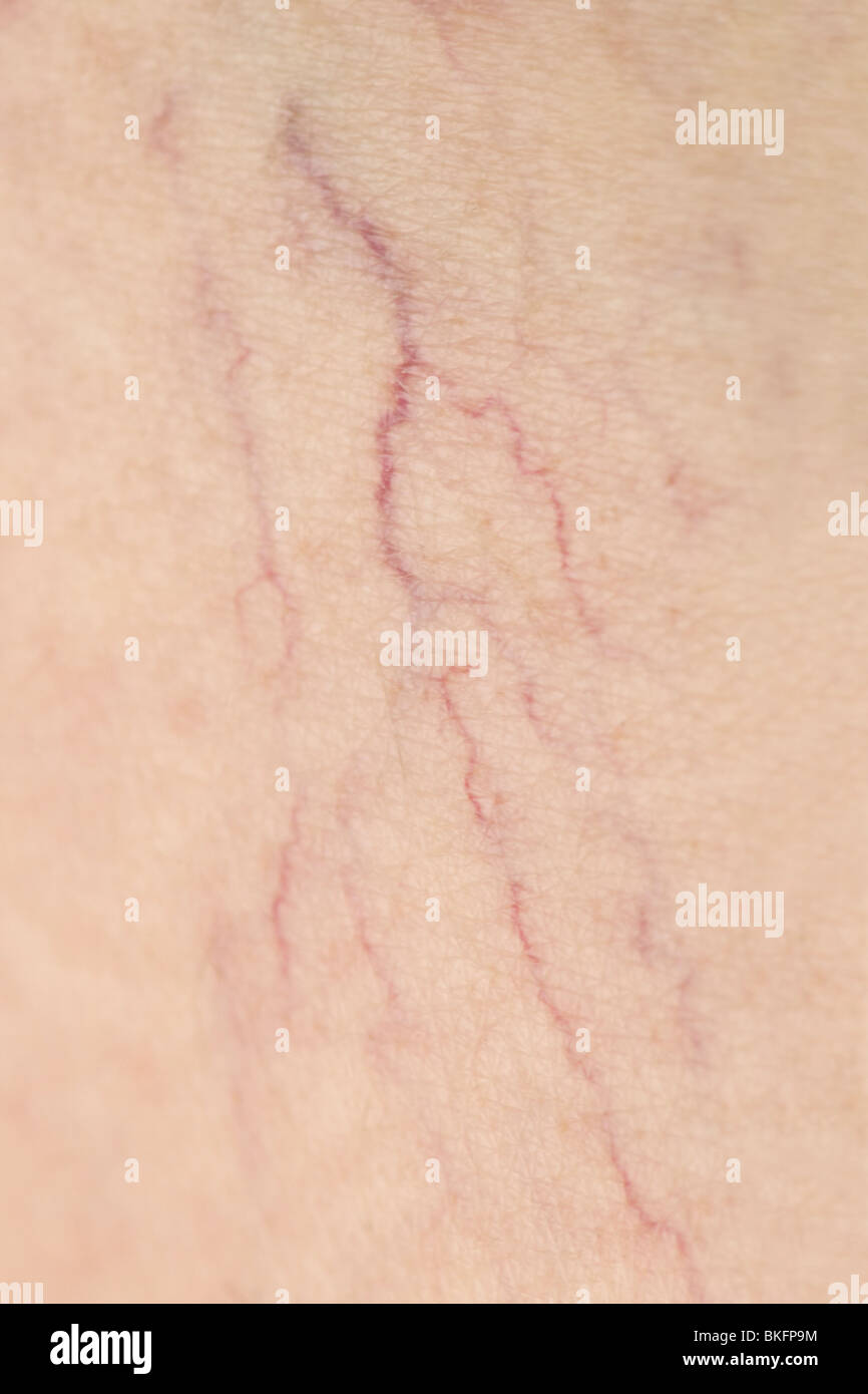 Red Lines Appear On Skin