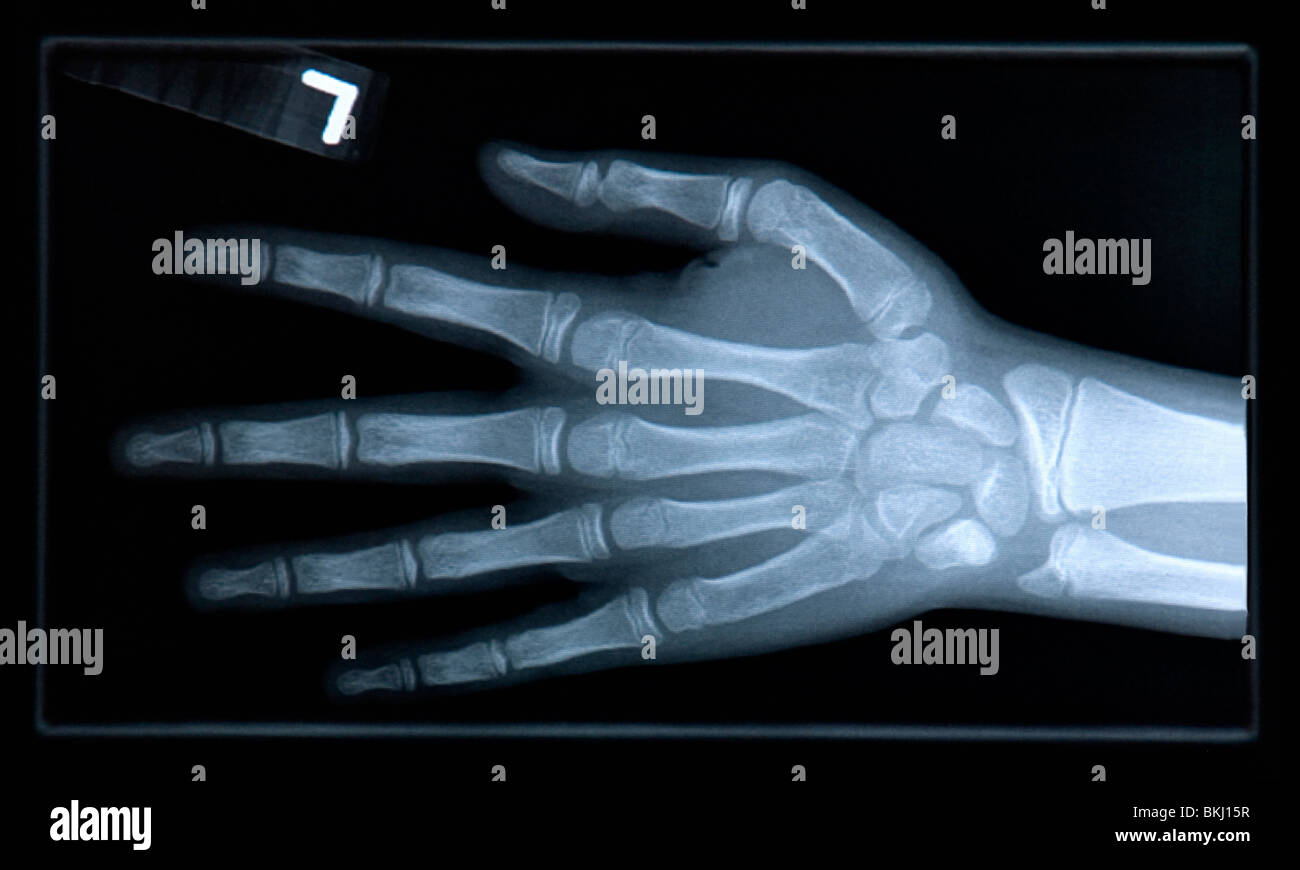 Close-up xray of hand Stock Photo - Alamy