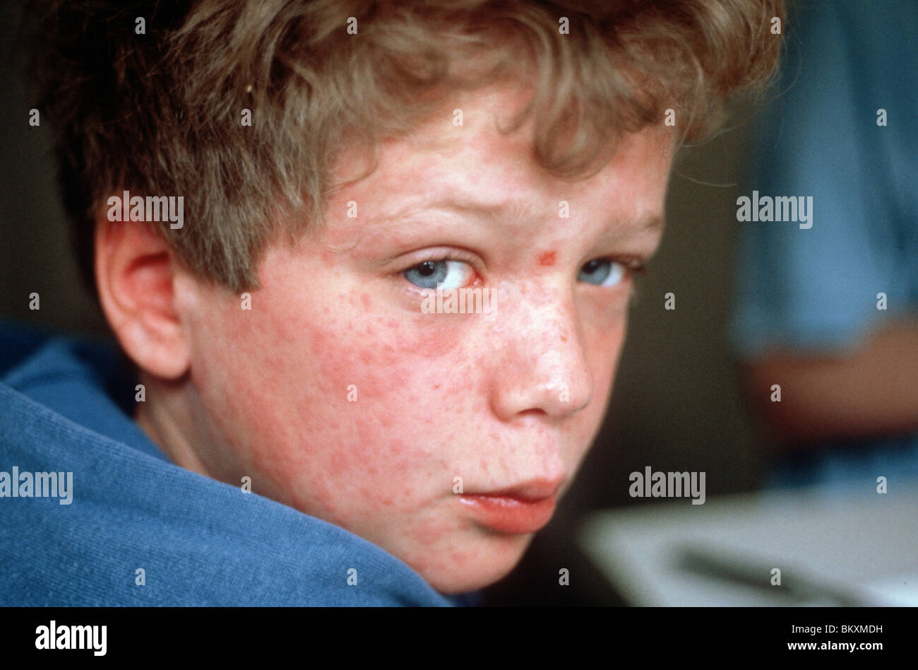 Childrens disease horizontal hi-res stock photography and images - Alamy