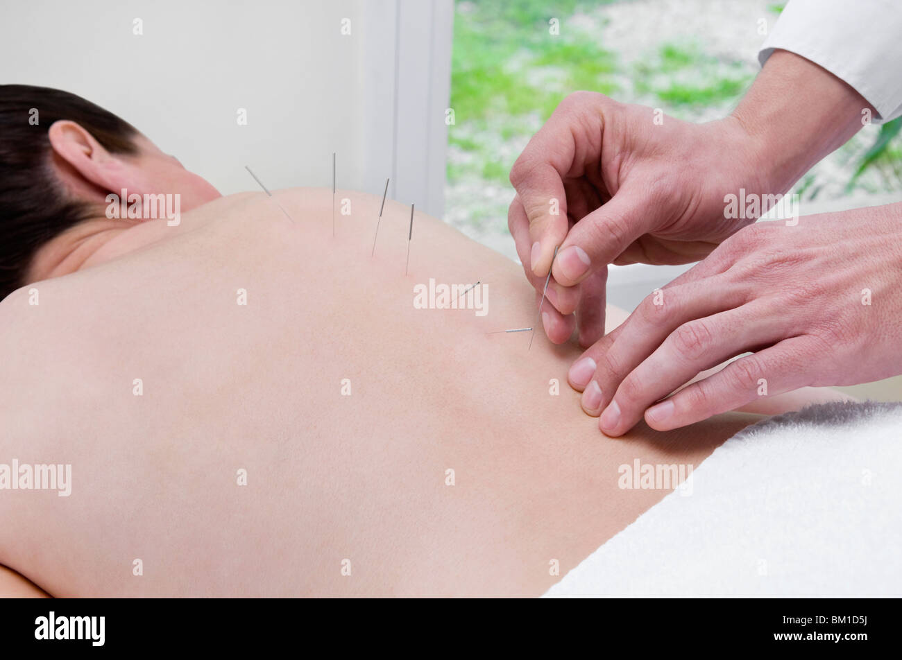 Applying acupuncture on skin hi-res stock photography and images - Alamy