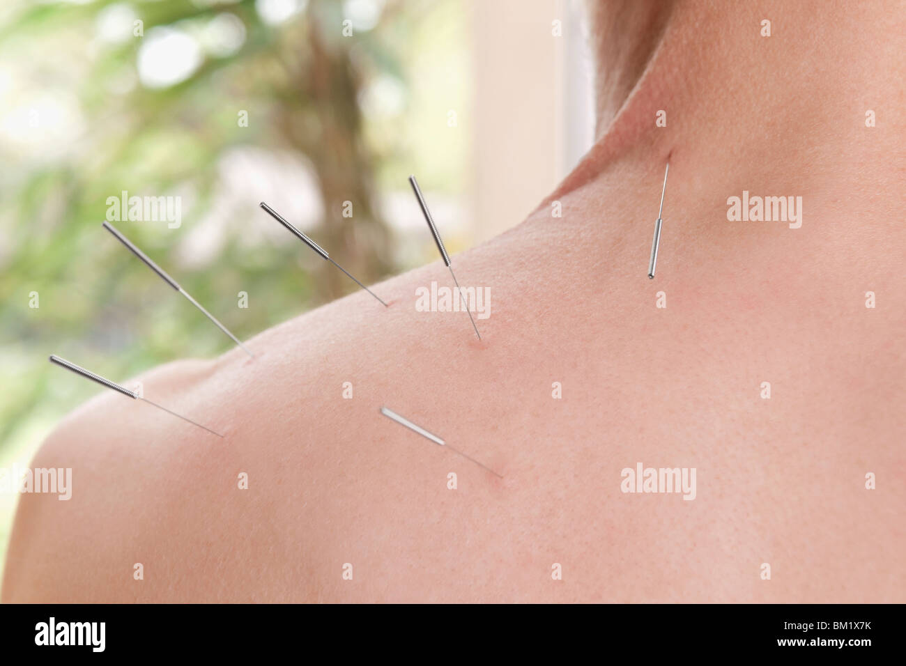 Acupuncture needles on a person's back Stock Photo - Alamy