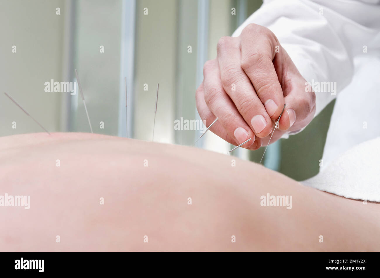 Applying acupuncture skin hi-res stock photography and images - Alamy