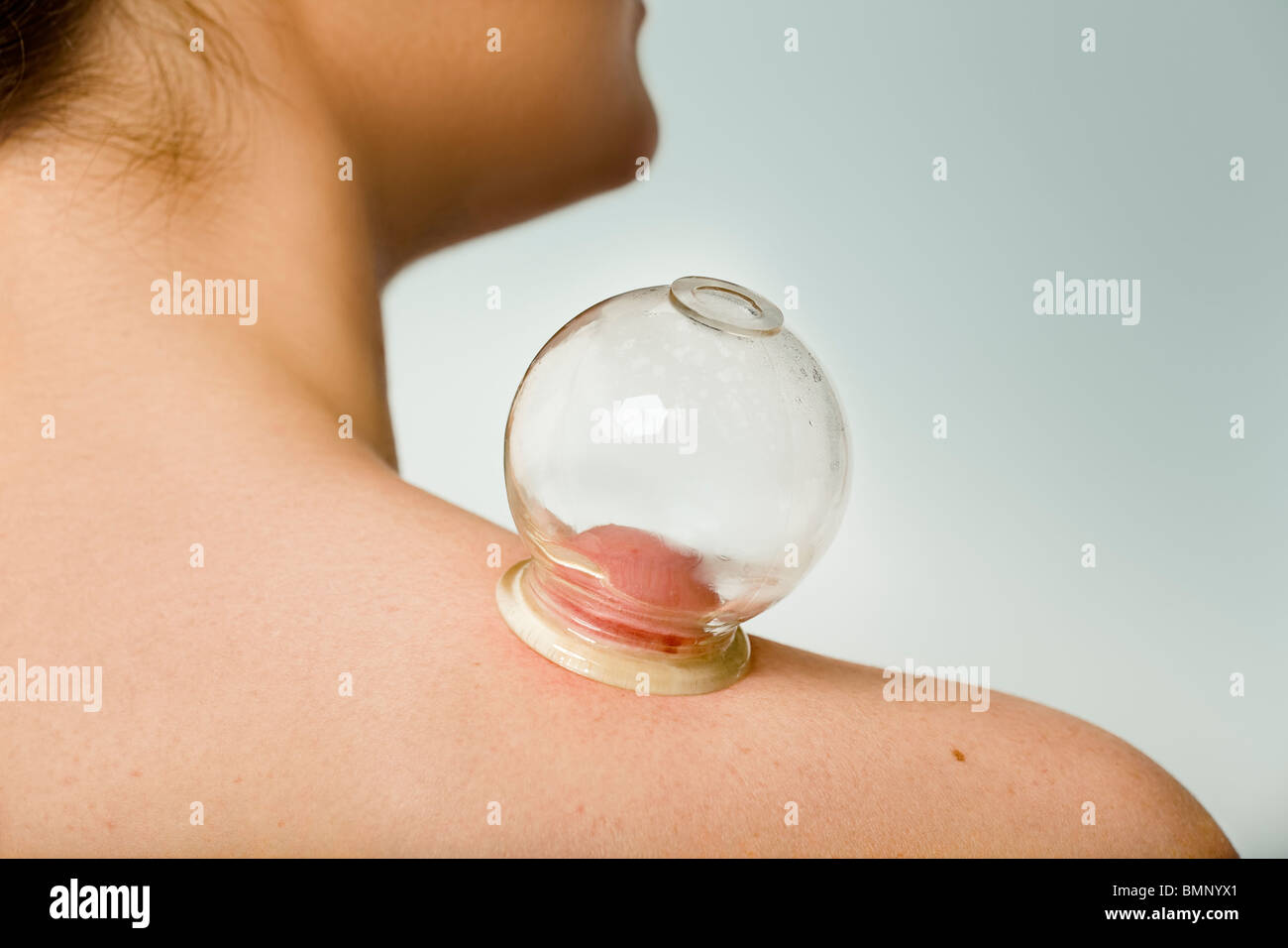 Cupping therapy neck hi-res stock photography and images - Alamy
