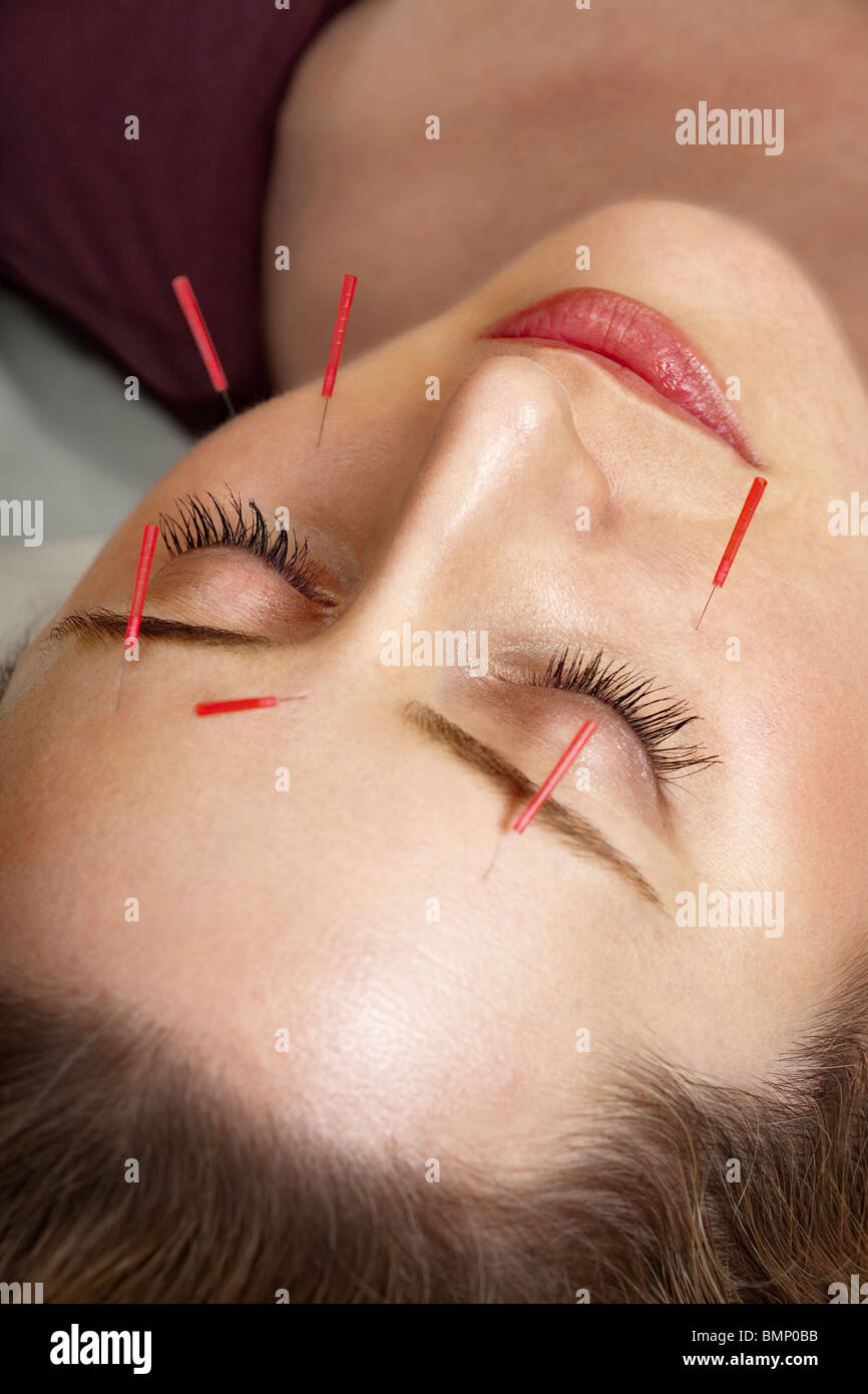 Female patient receiving acupuncture treatment to her face Stock Photo ...