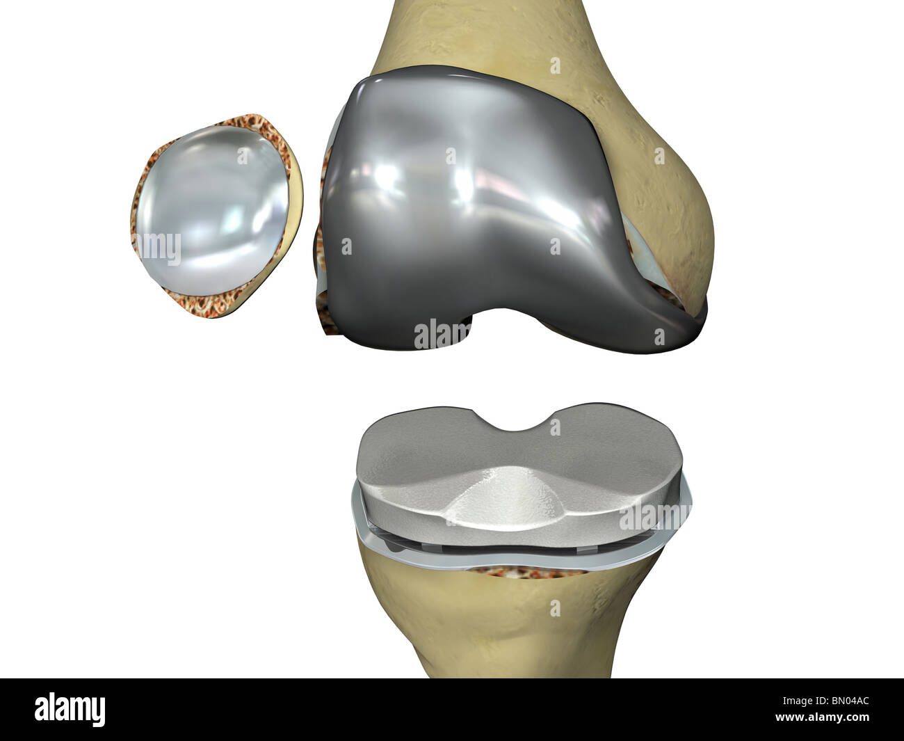 Total knee replacement hi-res stock photography and images - Alamy