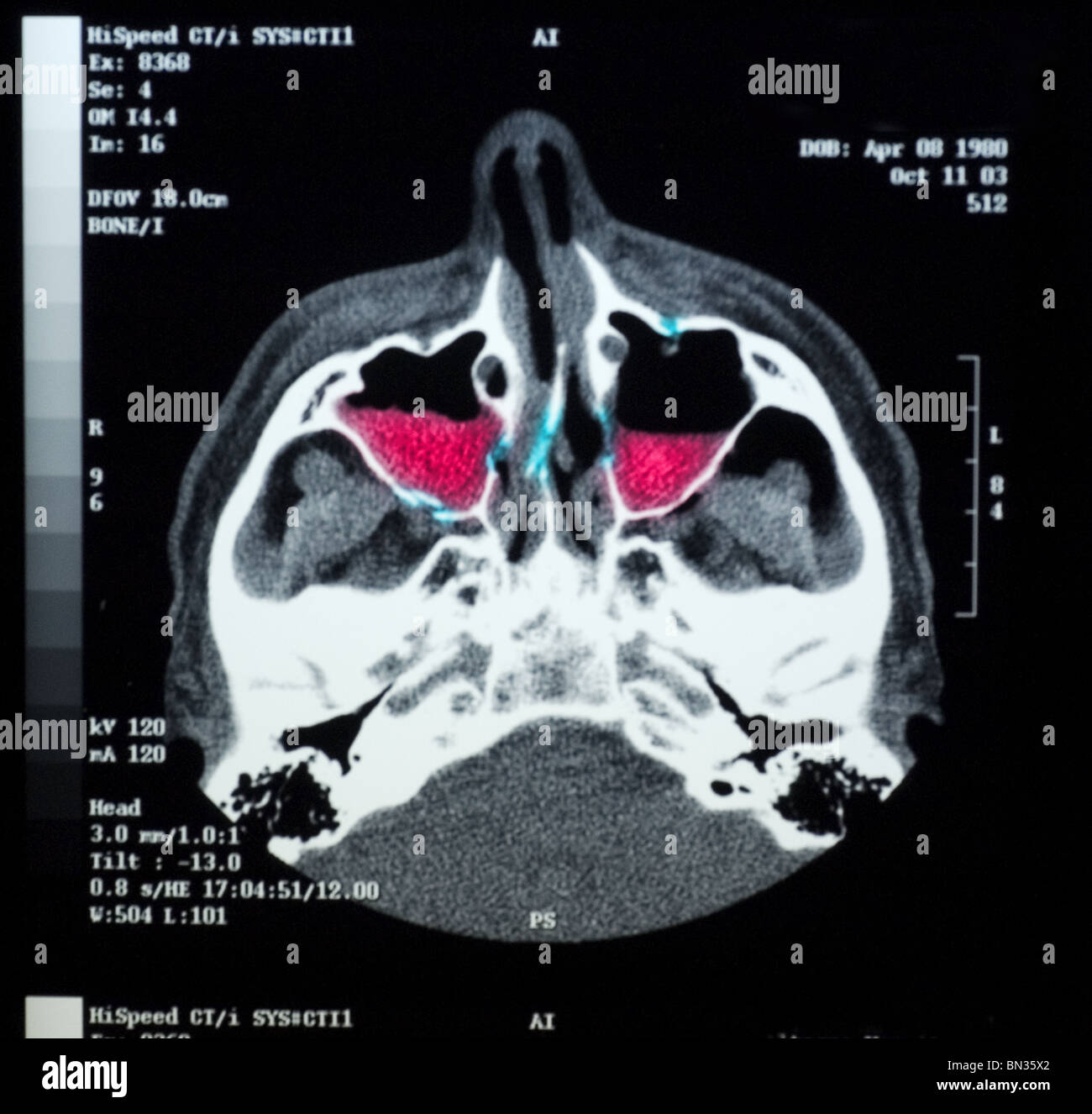 Maxillary bones hi-res stock photography and images - Alamy