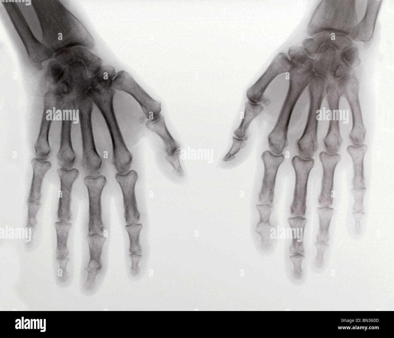 Hand x-rays showing rheumatoid arthritis Stock Photo - Alamy