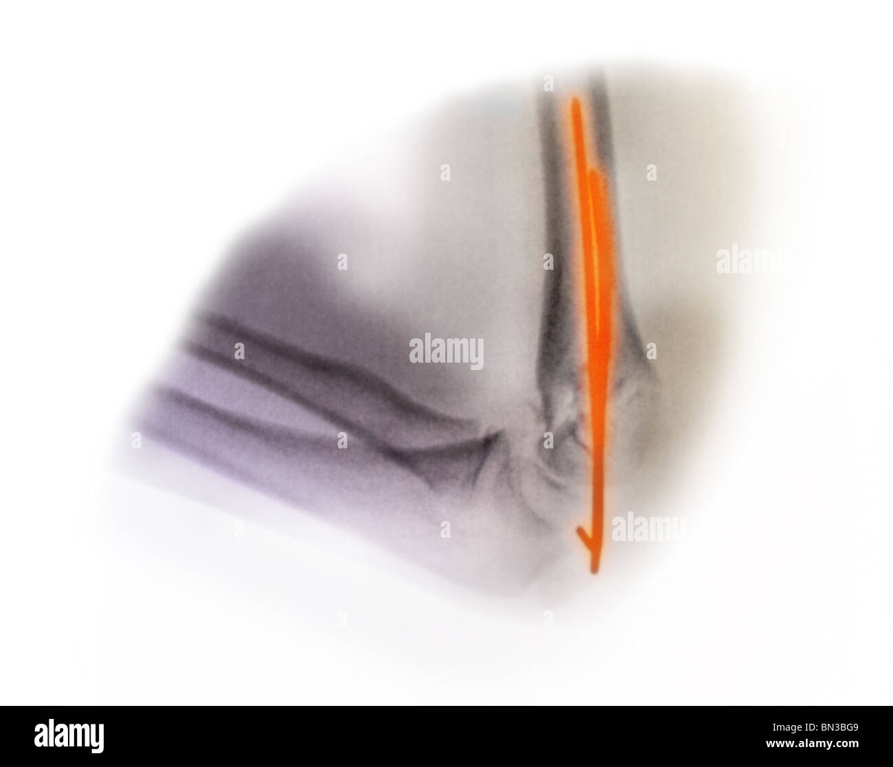 Fracture of humerus Cut Out Stock Images & Pictures - Alamy