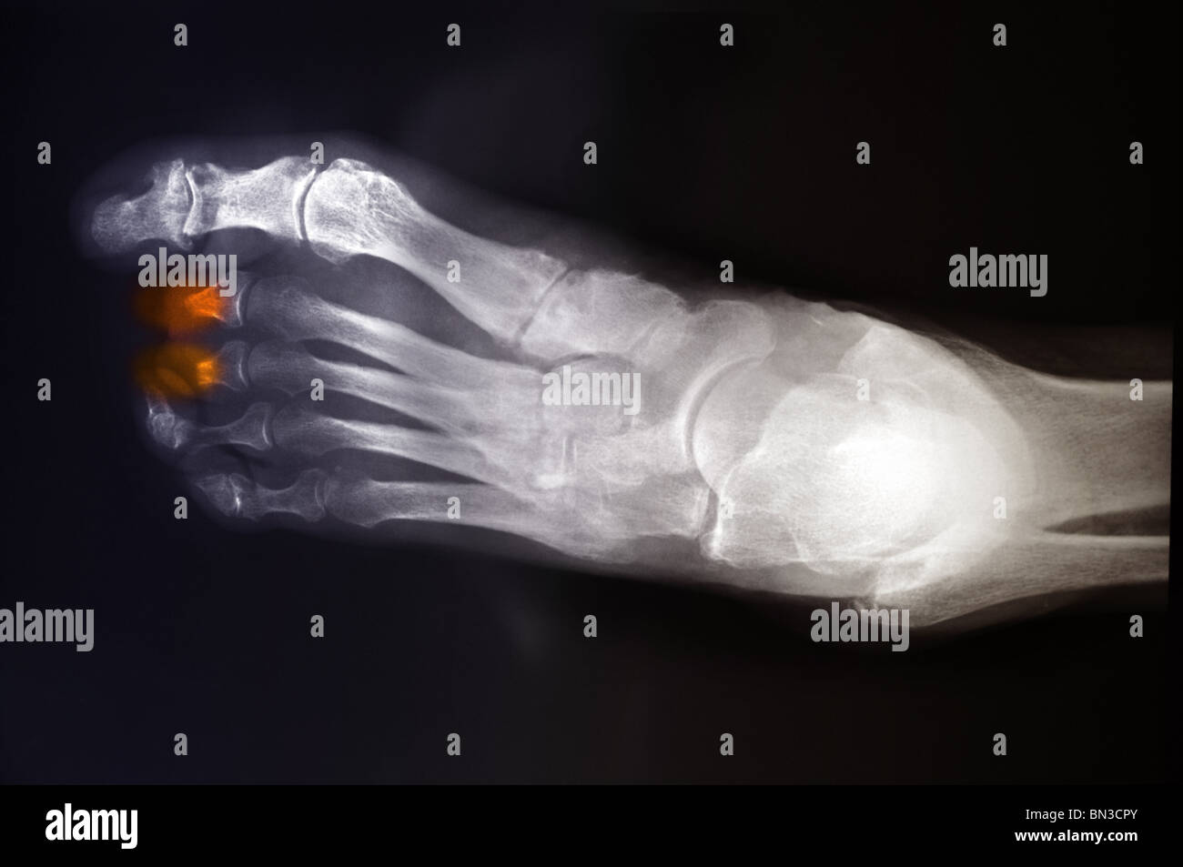 Amputation amputated hi-res stock photography and images - Alamy