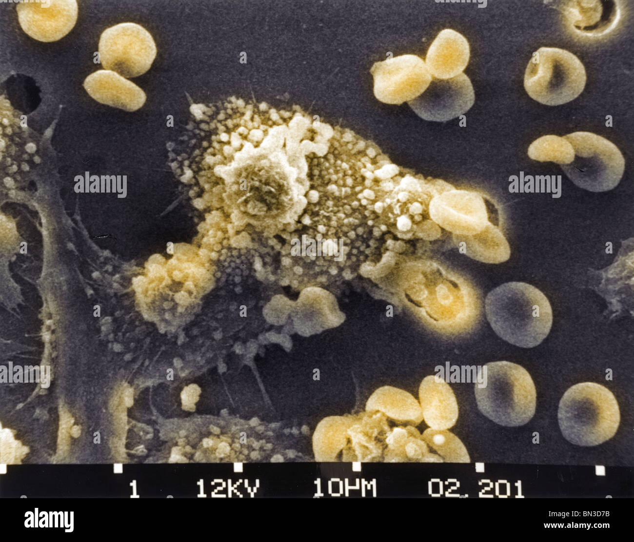 Cancer micrograph hi-res stock photography and images - Alamy