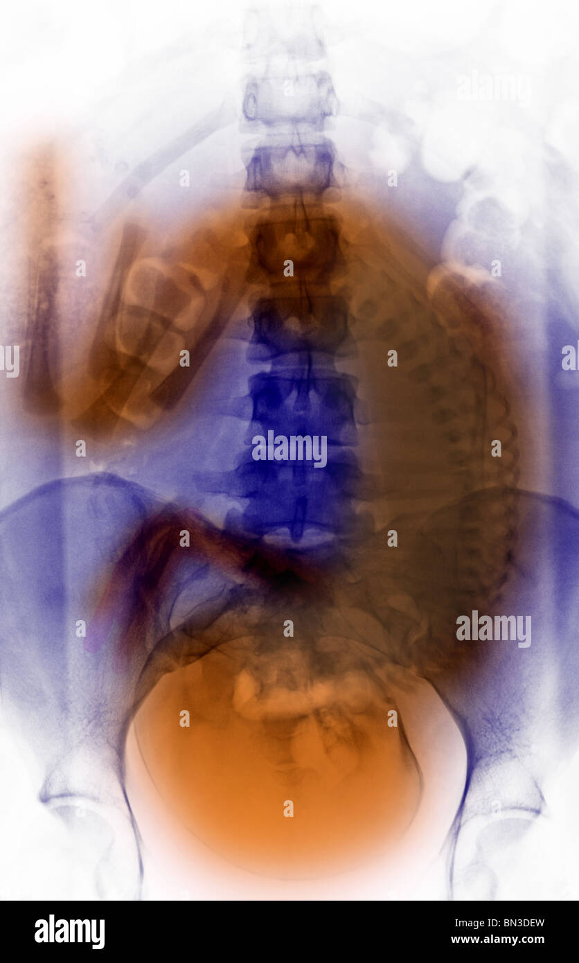 Full term fetus hi-res stock photography and images - Alamy