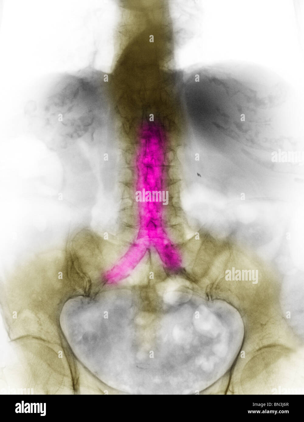 Atherosclerosis of the abdominal aorta hi-res stock photography and ...