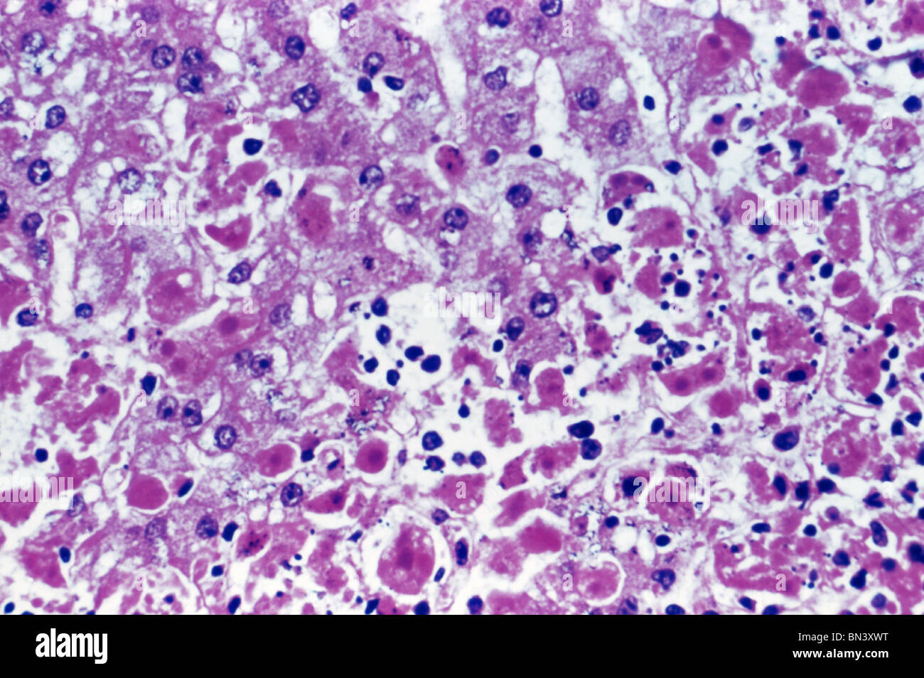 Light micrograph of human hepatocytes (liver cells) infected with the ...