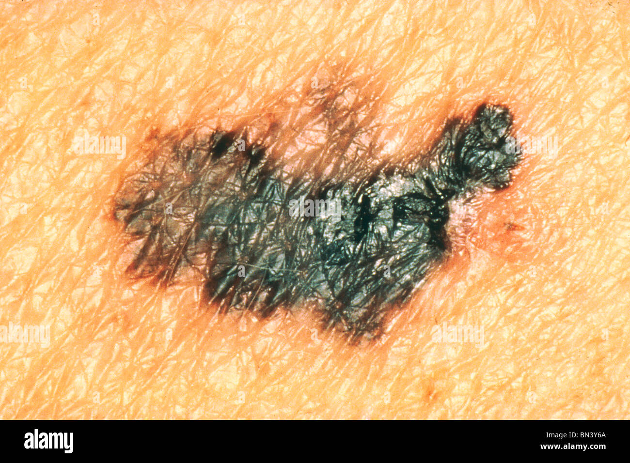 Melanoma (Skin Cancer) with coloring of different shades of brown ...