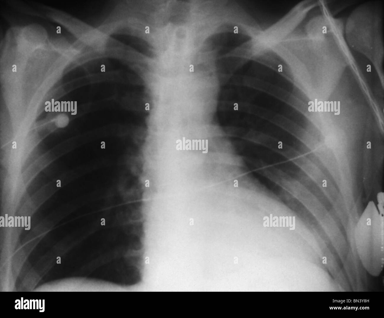 Chest x-ray showing a resolving plague infection with clearing in the ...