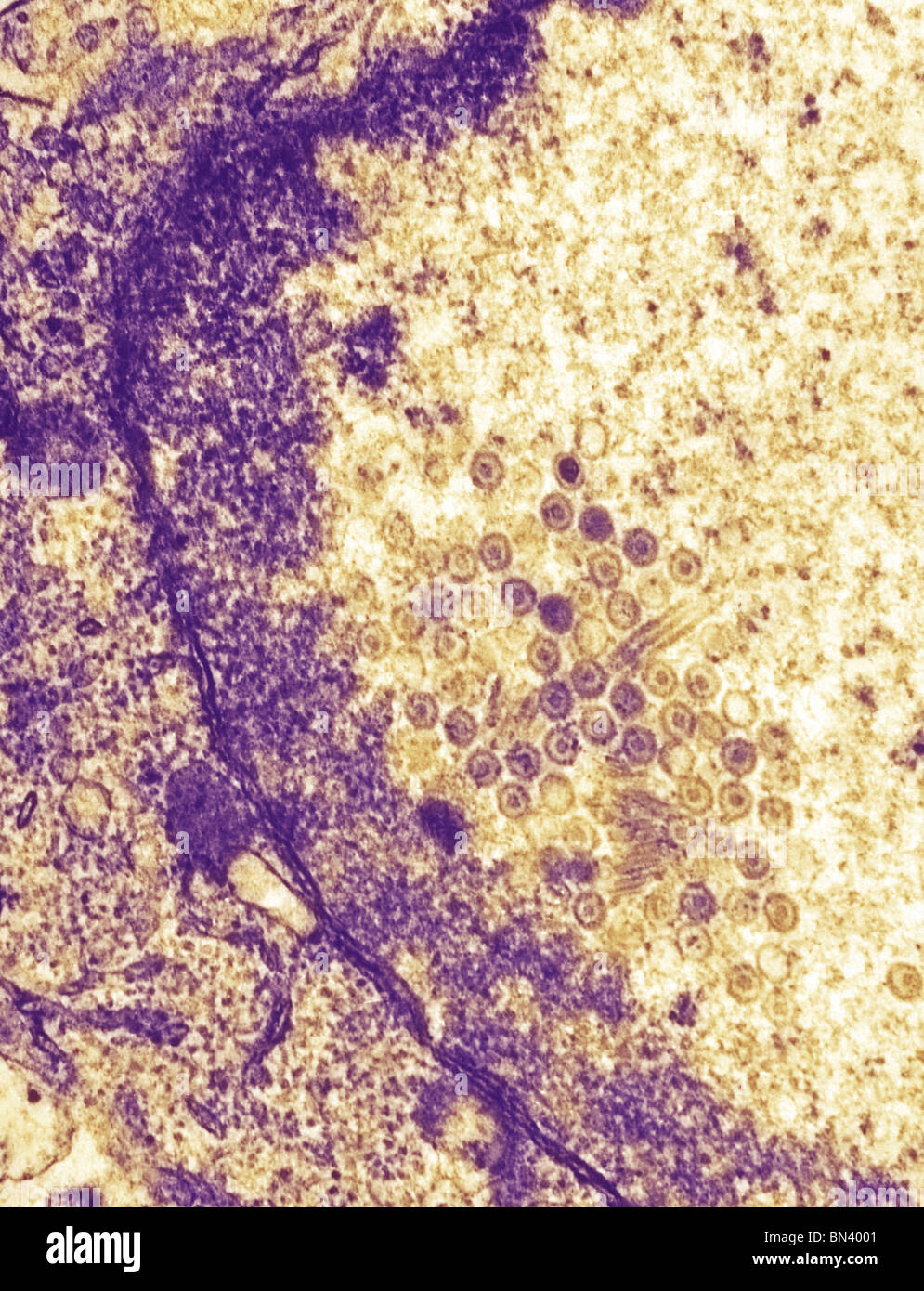Ependymoma Blepharoplasts
