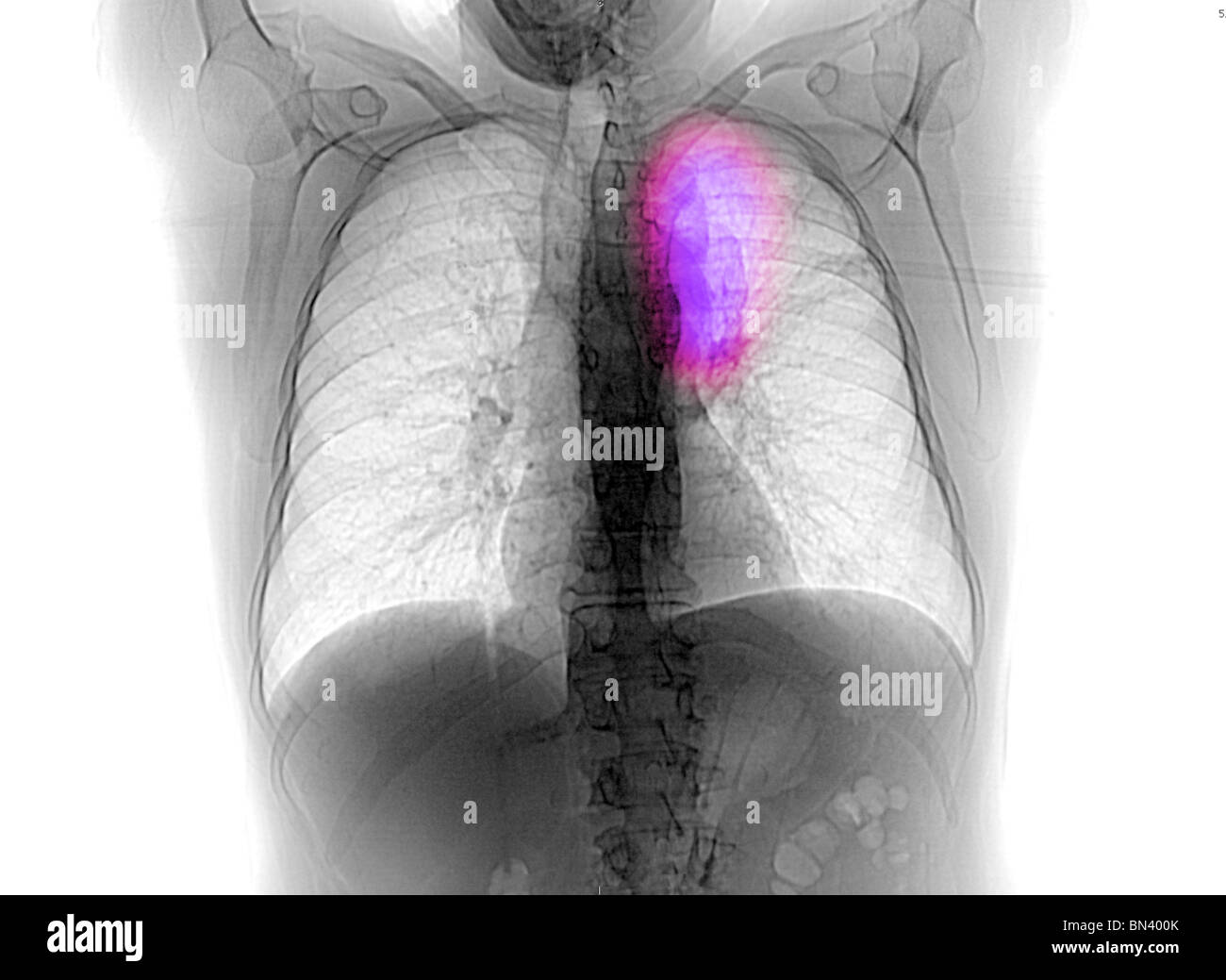 CT scan scout image from a 54 year old man with lung cancer Stock Photo ...