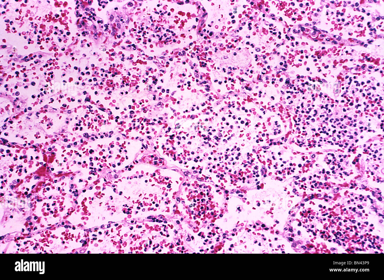 Light photomicrograph of the histopathologic changes in lung tissue in ...
