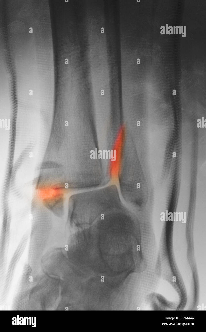 Bimalleolar ankle hi-res stock photography and images - Alamy