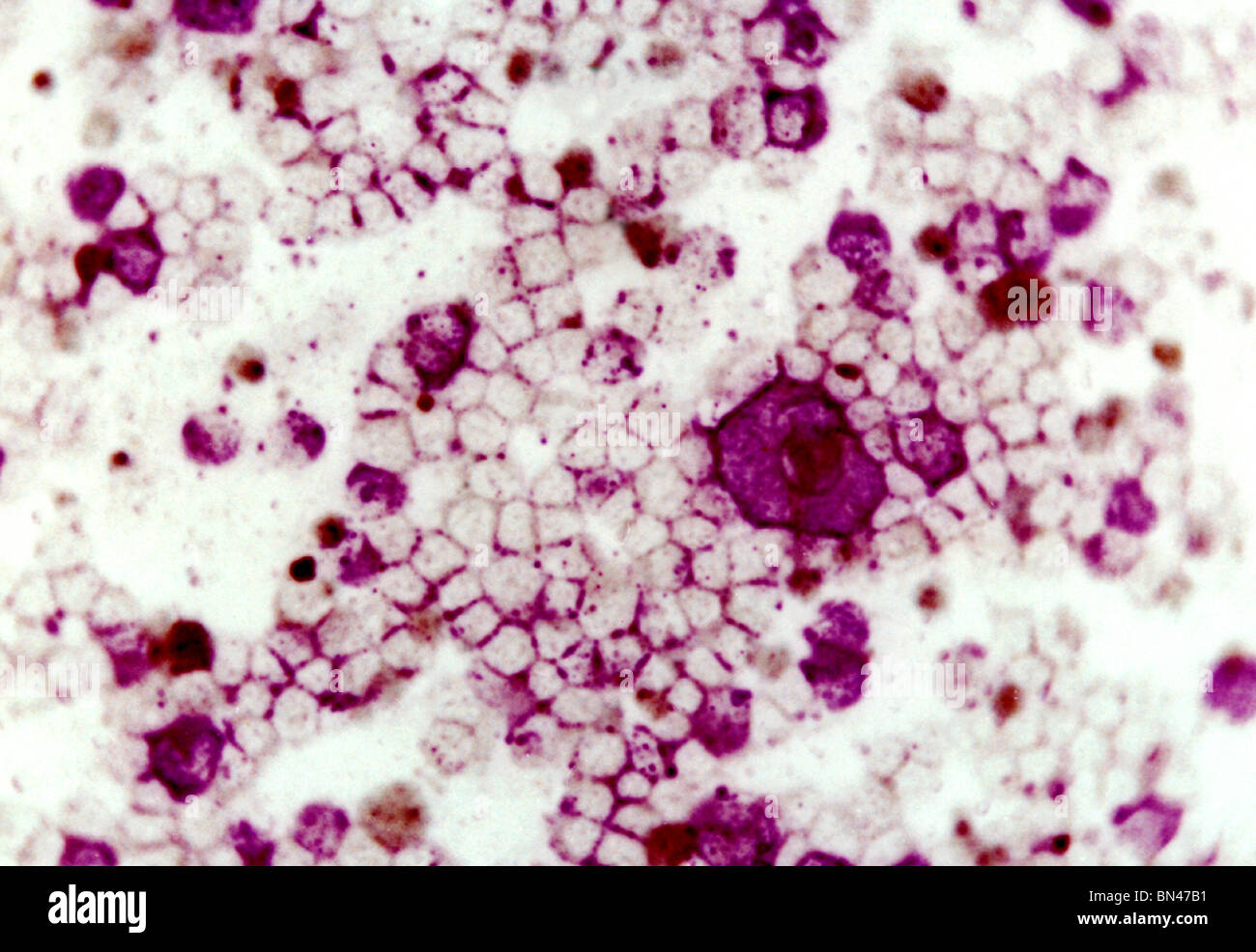 Photomicrograph showing respiratory syncytial virus (RSV) using ... Photomicrograph showing respiratory syncytial virus (RSV) using ...