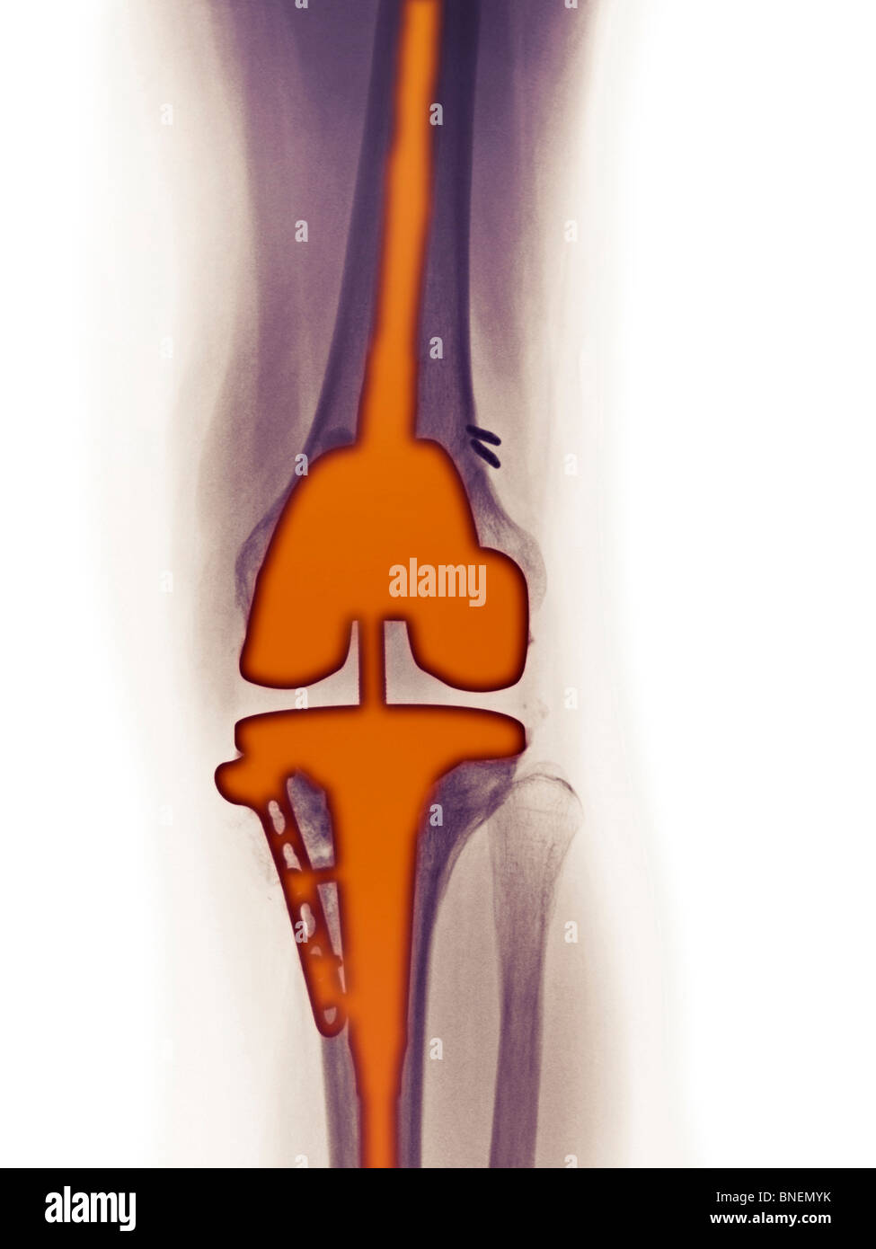 x-ray of a total knee replacement Stock Photo - Alamy