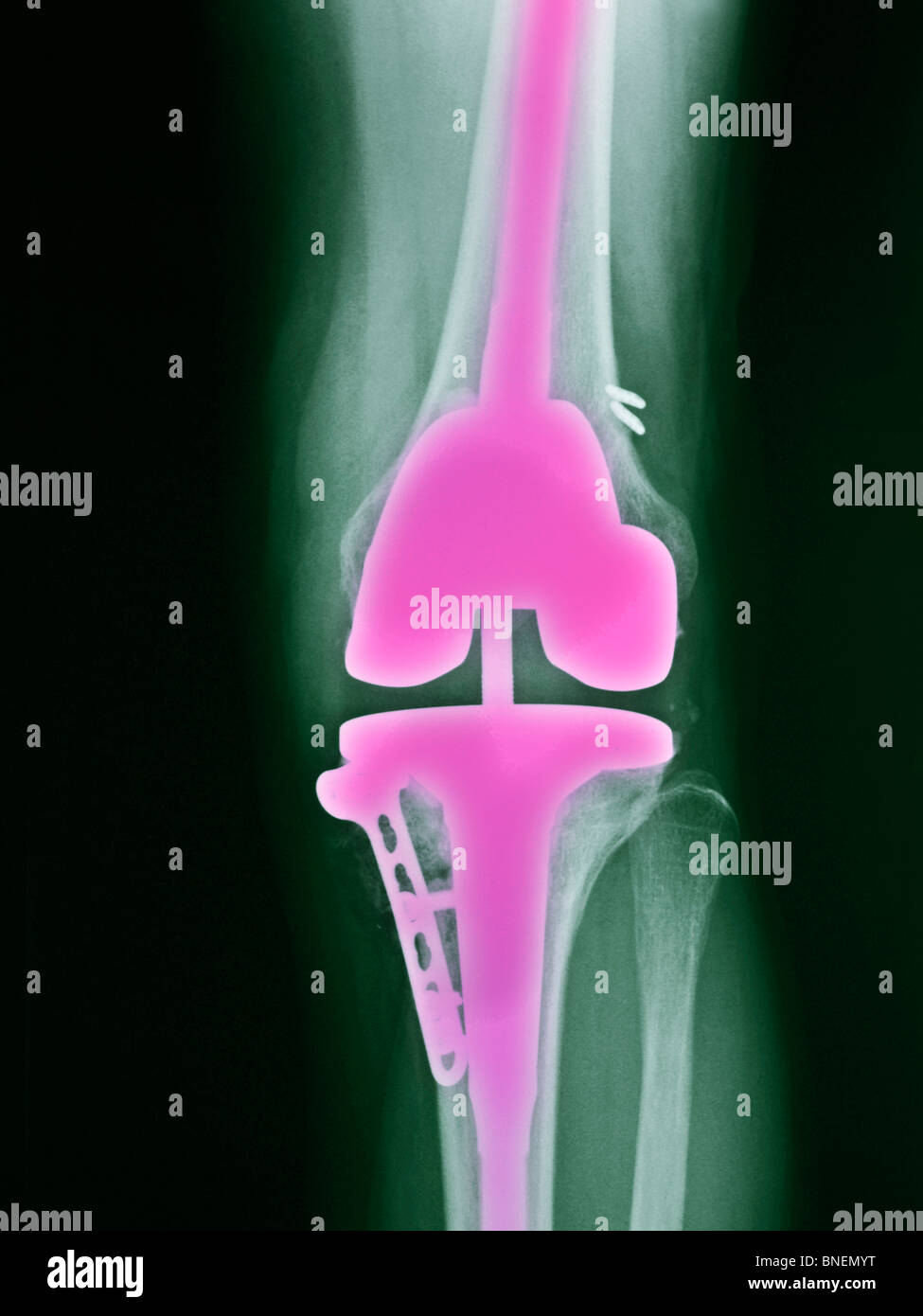 Total knee replacement x ray hi-res stock photography and images - Alamy