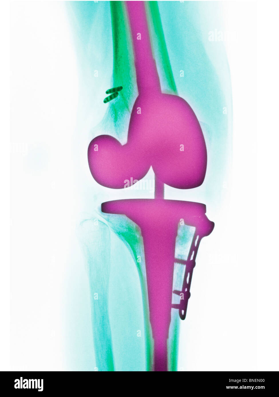 Total knee replacement hi-res stock photography and images - Alamy