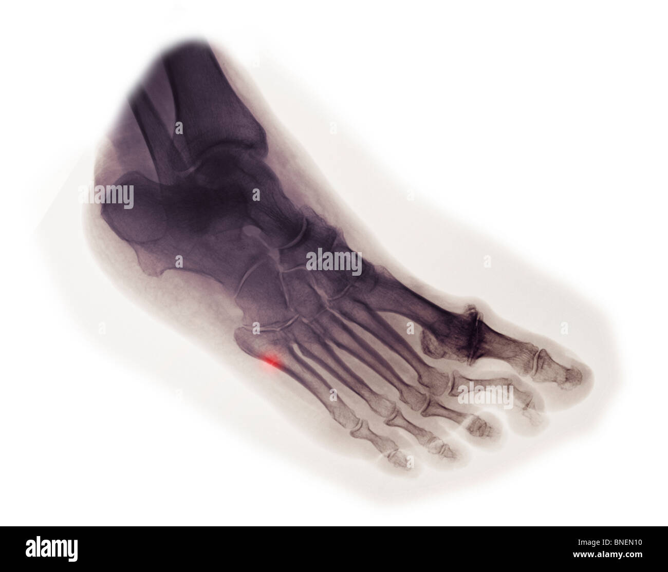 Fractured foot hi-res stock photography and images - Alamy